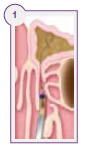 Relieva Balloon Sinuplasty | ENT Specialists